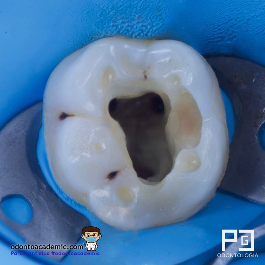 Endodoncia Primer Molar Inferior 3 Conductos - ODONTOACADEMIC
