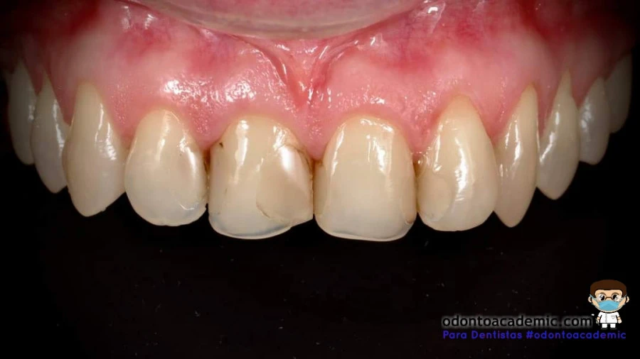 Restauracion directa con resina en dientes anteriores - ODONTOACADEMIC