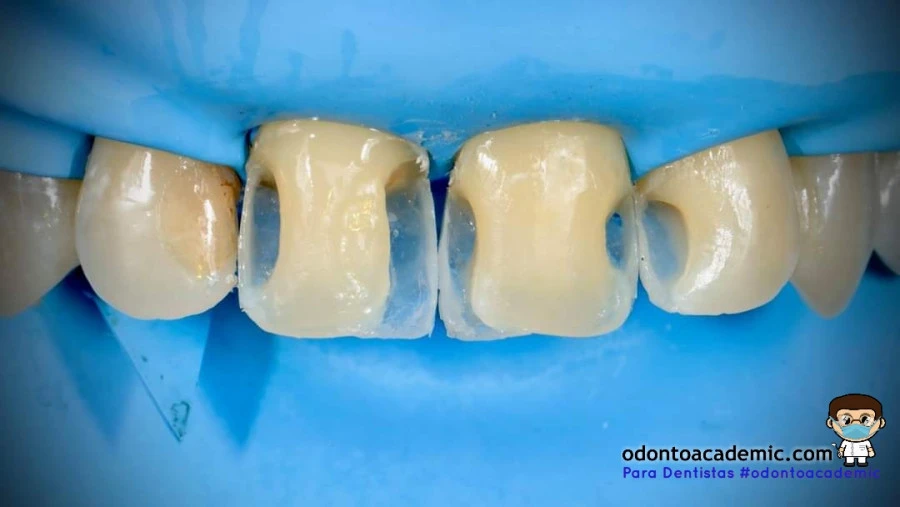 Restauracion directa con resina en dientes anteriores - ODONTOACADEMIC