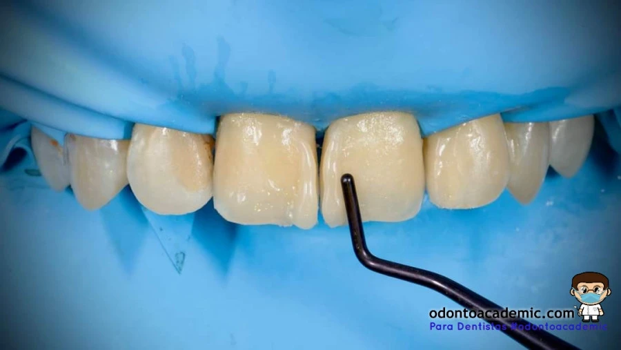 Restauracion directa con resina en dientes anteriores - ODONTOACADEMIC