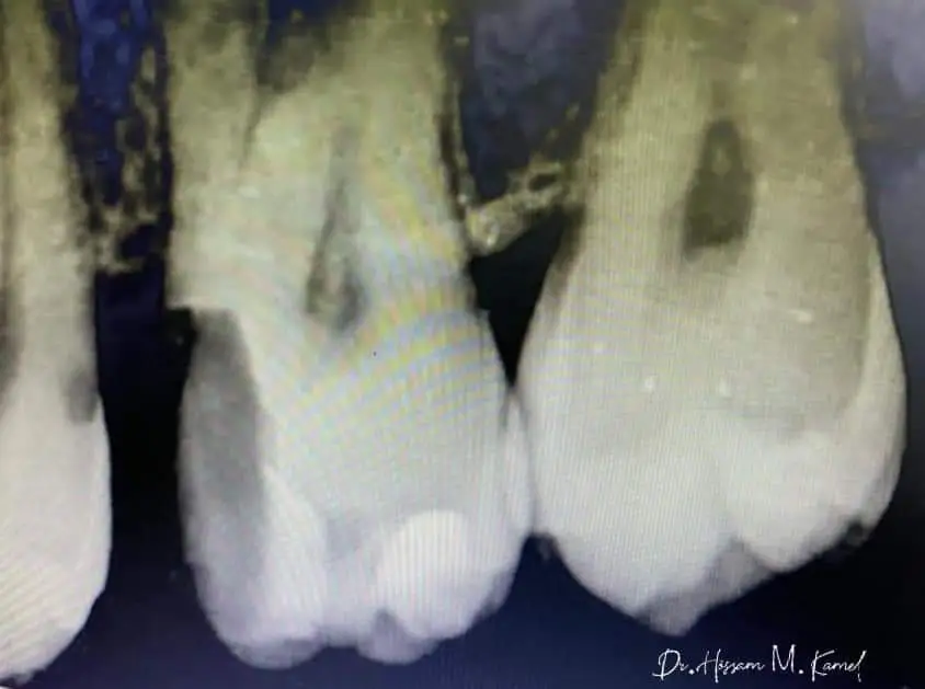 Restauración interproximal con sistema matriz ( molar superior ...